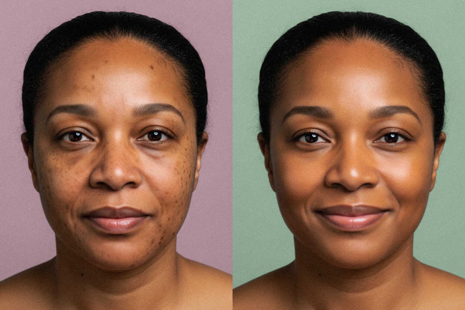 8 Best Products for Hyperpigmentation - Skincare - Blog | SybilCreates